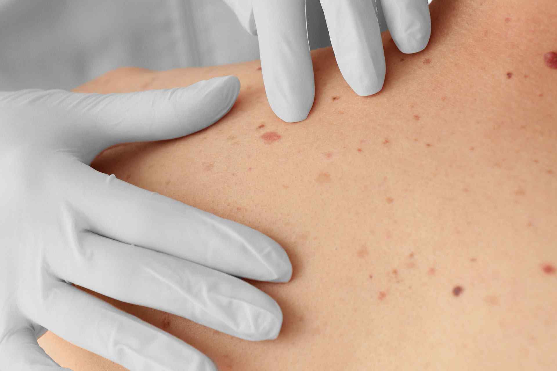 Causes of Poikiloderma of Civatte